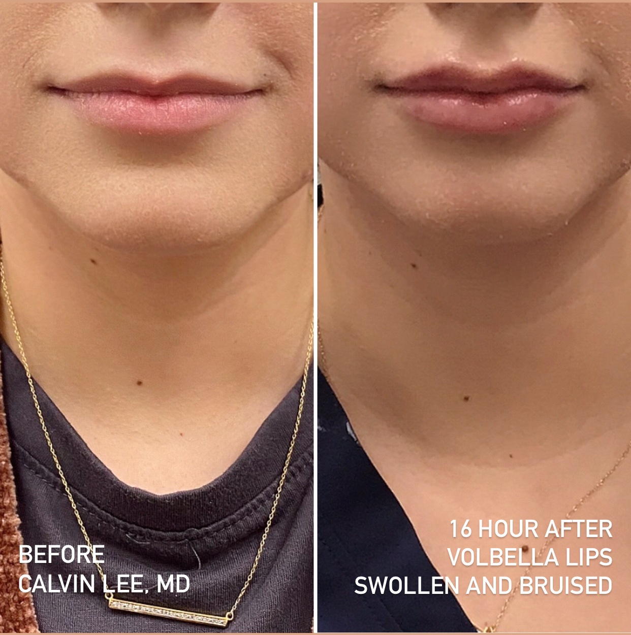 Lip filler experience – Modesto Botox, Dr. Calvin Lee